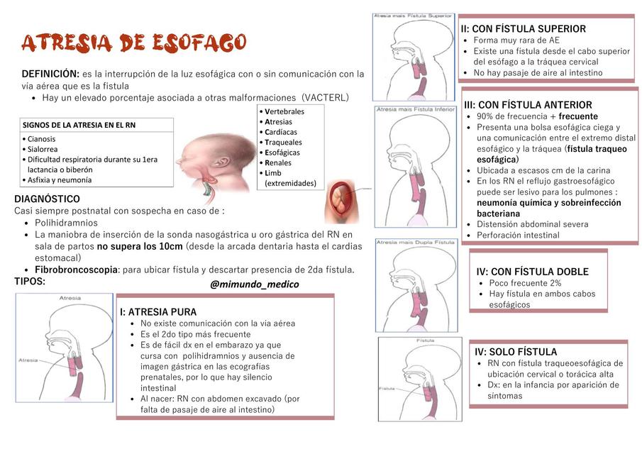 Atresia Esófago | Laura | uDocz