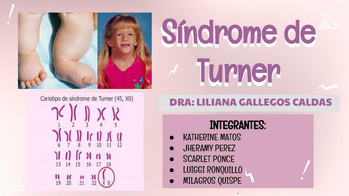 Flashcards de Síndrome de Turner | Por Antuanet J.P Pérez | uDocz