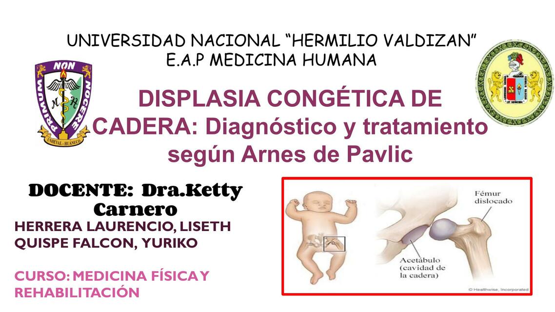 Displasia Congénita de Cadera | Jason Mario Flores Hidalgo | uDocz