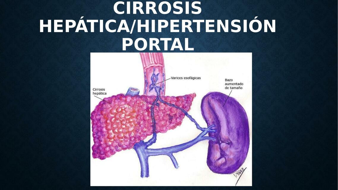 Cirrosis Hepática/ Hipertensión Portal | Angie Montalvo | uDocz