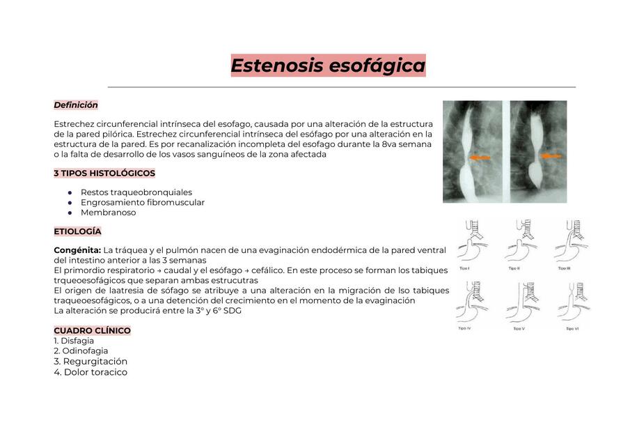 Estenosis esofágica | Angela Dominguez | uDocz