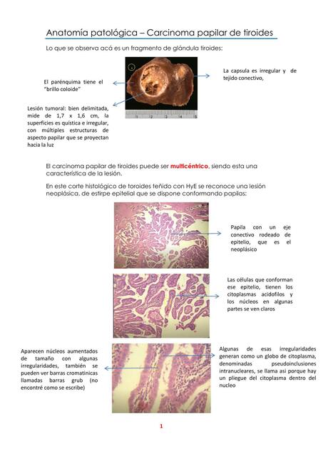 Anatomía Patológica – Carcinoma Papilar de Tiroides | Medicina en la UNER | uDocz