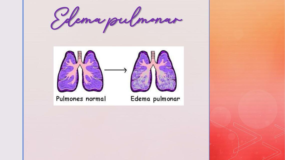 Edema pulmonar | Alejandra Salazar | uDocz