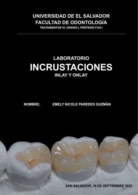 Restauraciones Indirectas en sector Posterior - Incrustaciones | Nicole ...