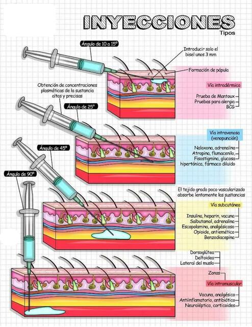 Tipos de inyecciones | fraii | uDocz