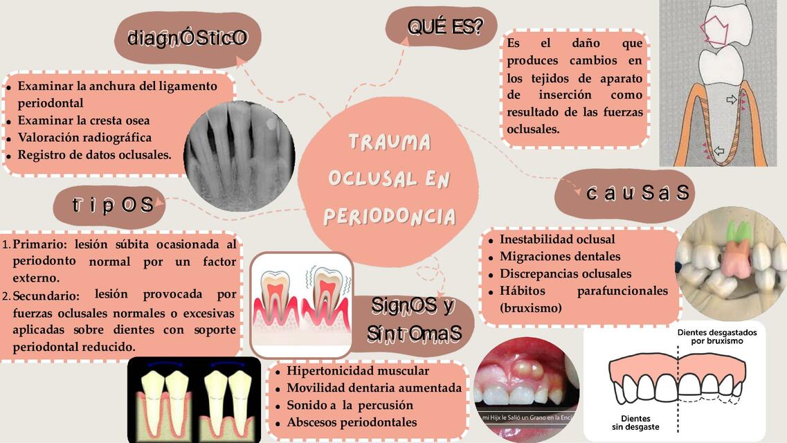 Trauma oclusal en periodoncia | Ana Pérez | uDocz