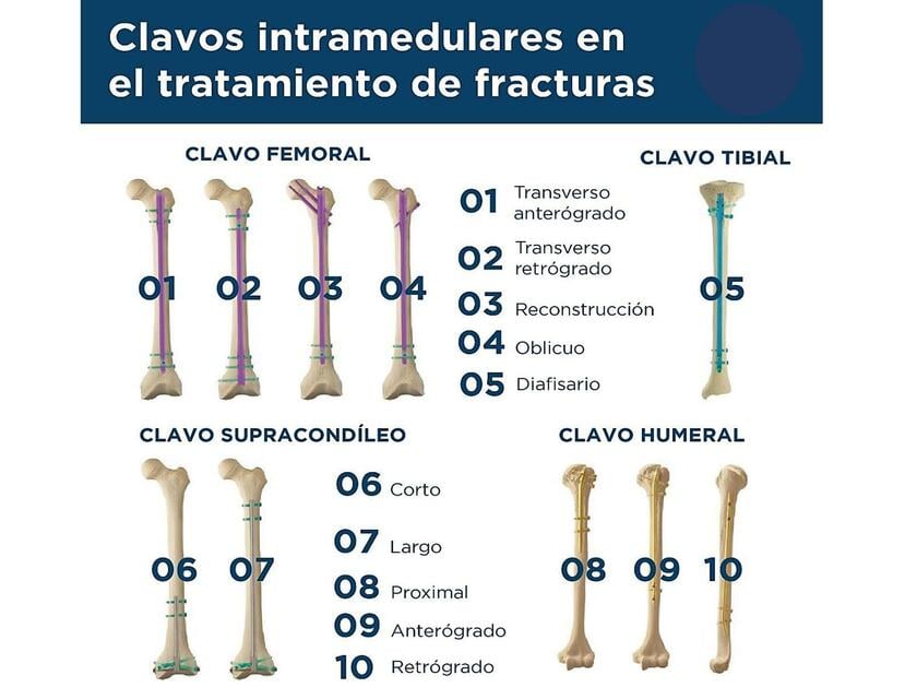 Clavos intramedulares en el tratamiento de fracturas. | fraii | uDocz