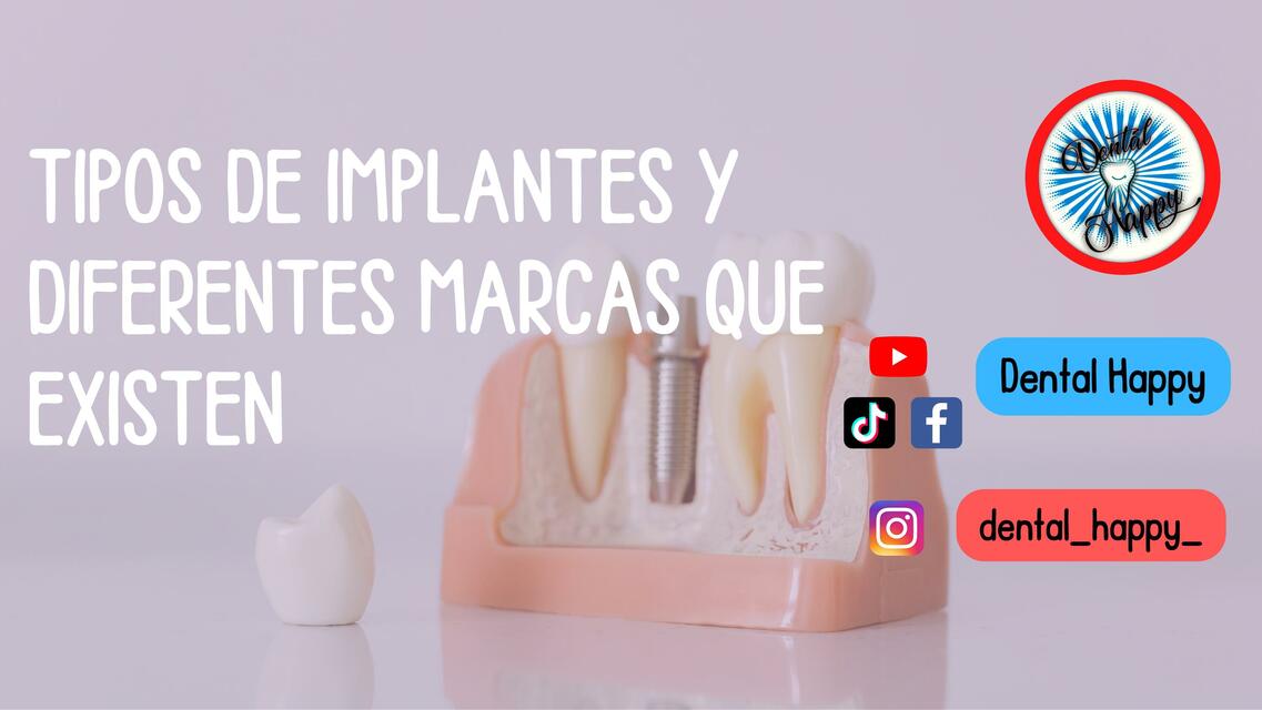 Tipos de implantes y diferentes marcas que existen | Alan Díaz | uDocz