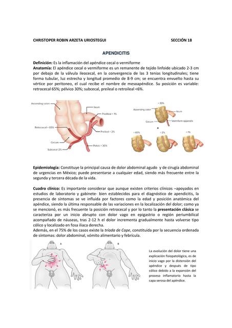 Apendicitis | uDocz