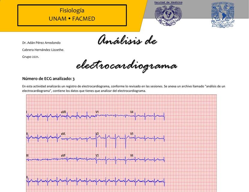Análisis de un Electrocardiograma | Alisson Gomora Gonzalez | uDocz