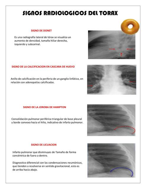 Signos radiológicos del Tórax | Selva yazbeth Espinoza Villavicencio ...