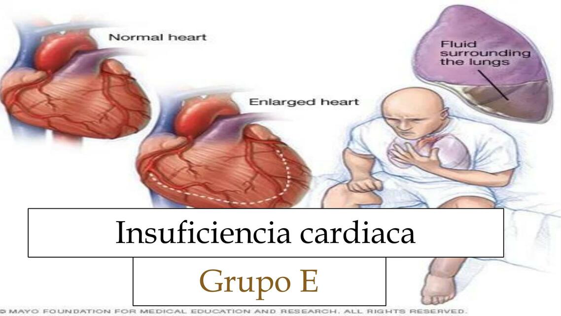 Insuficiencia Cardiaca | carmen Javier | uDocz