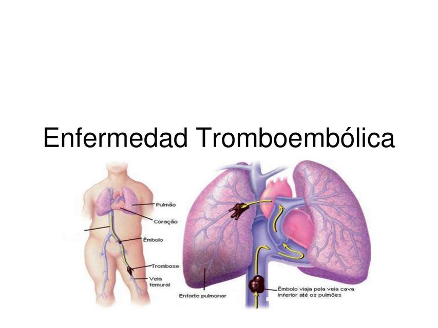 Enfermedad Tromboembólica | MEDilove | uDocz