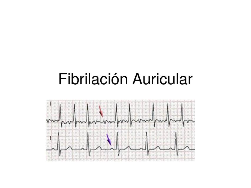 Fibrilación Auricular | MEDilove | uDocz