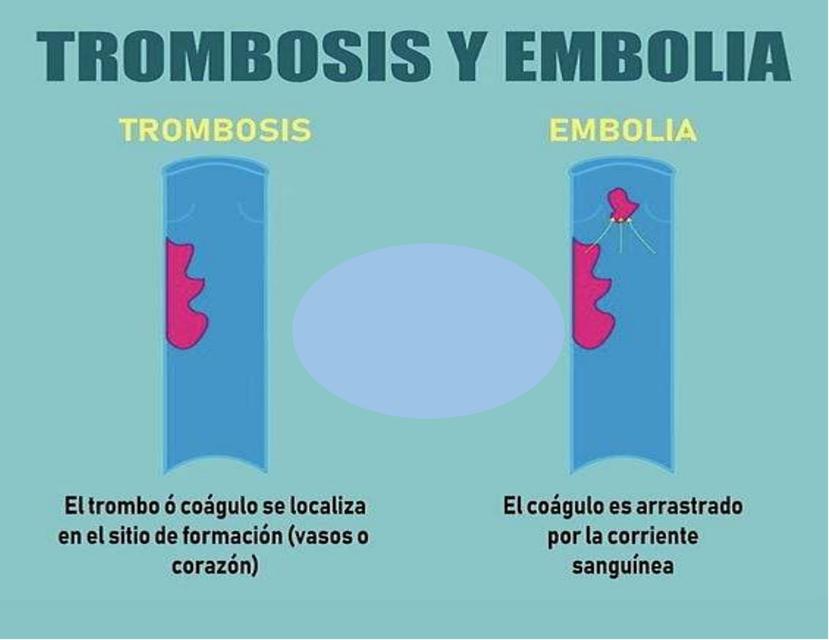 Trombosis y embolia | fraii | uDocz