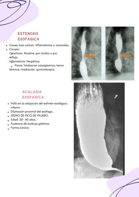 Resúmenes de Esofágica | Descarga apuntes de Esofágica
