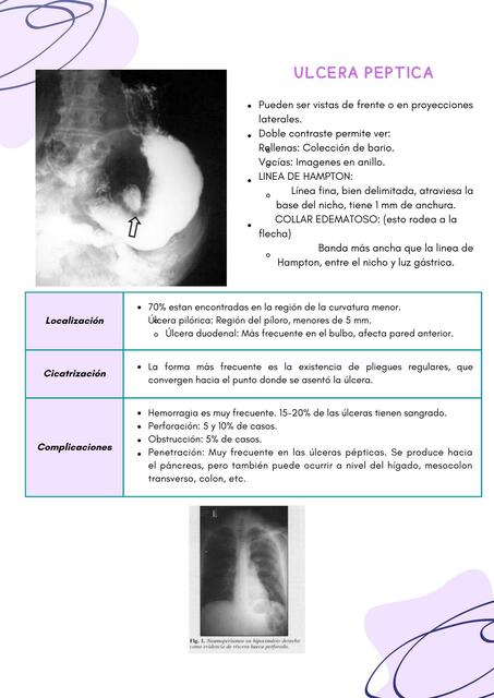 Úlcera péptica | MARYURI LISBETH | uDocz