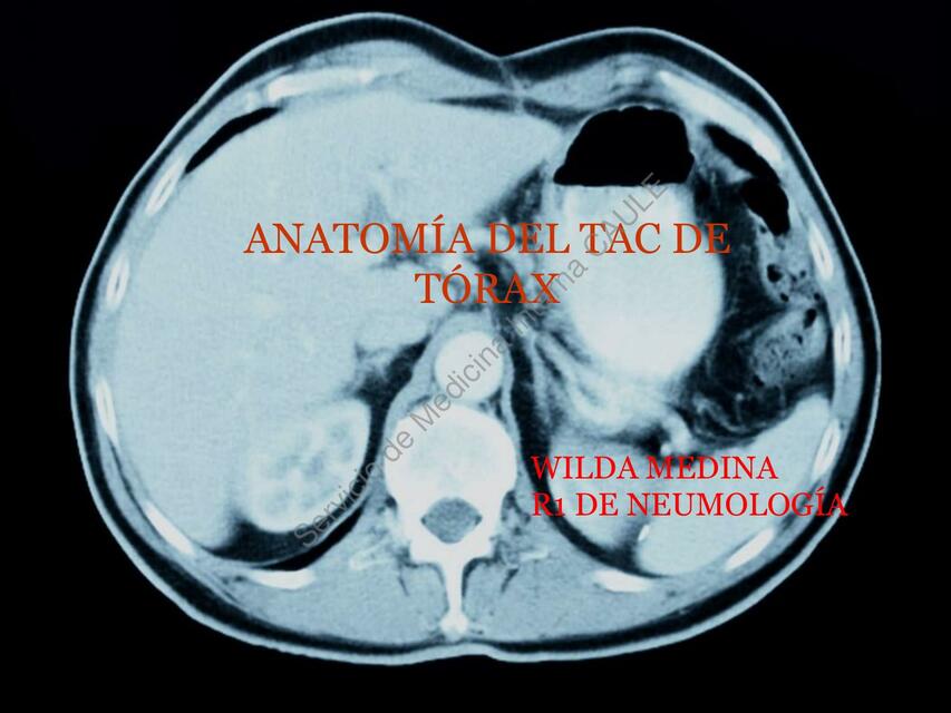 TAC de Tórax Mediastino | Lilibeth Zambrano | uDocz