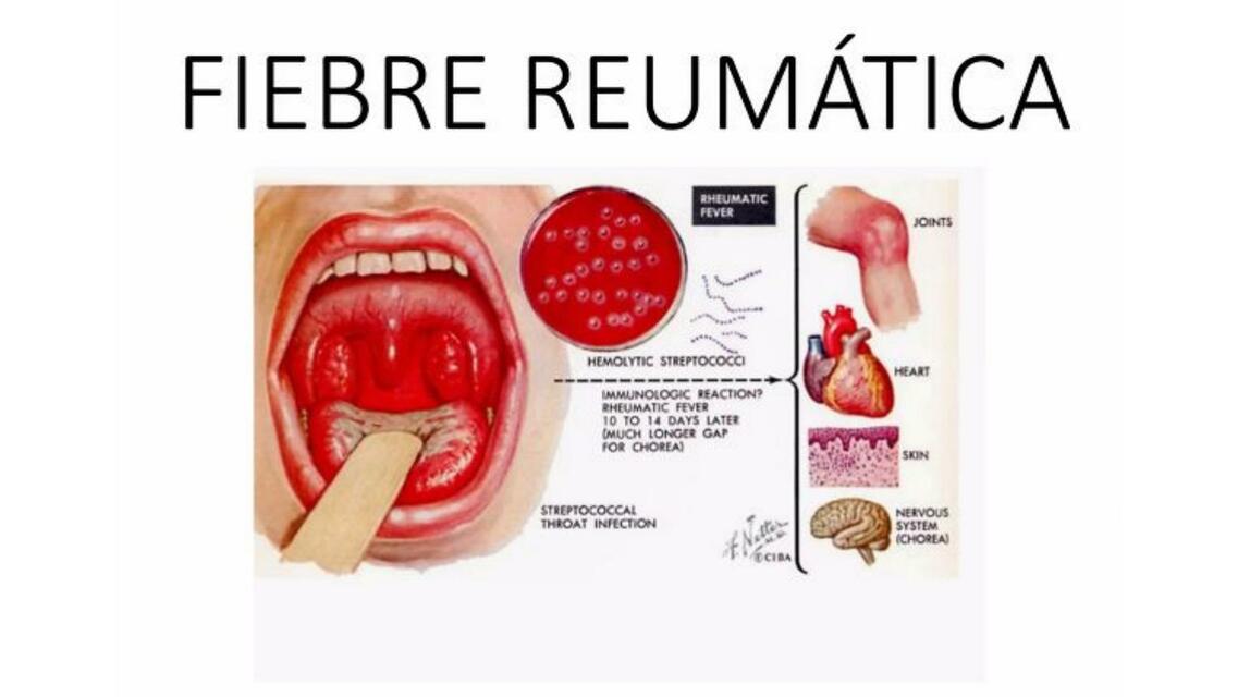 7. Fiebre Reumática | LiquidOH愛 | uDocz