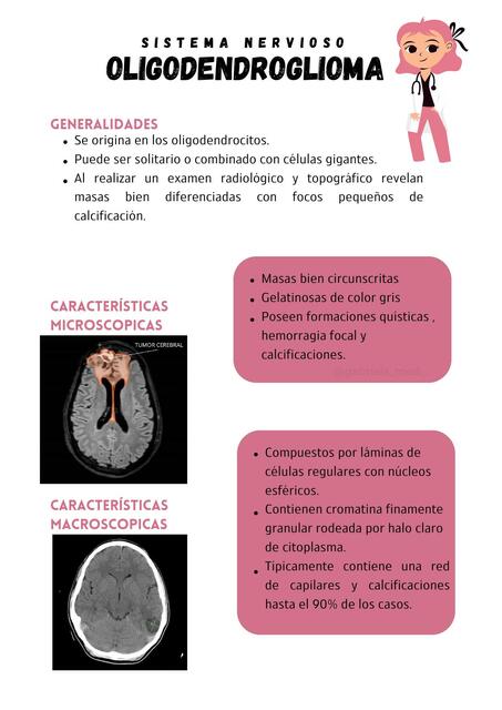 Oligodendroglioma | MARYURI LISBETH | uDocz