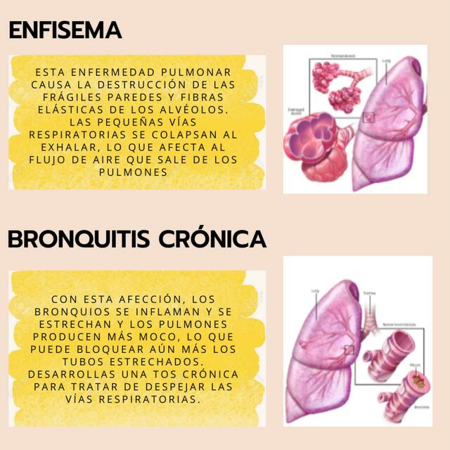 Enfisema y bronquitis crónica | MARYURI LISBETH | uDocz Enfisema y bronquitis crónica | MARYURI LISBETH | uDocz