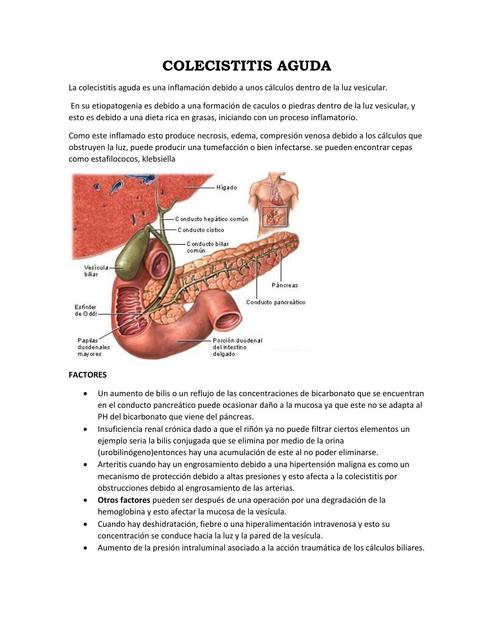 Colecistitis aguda | Mary Acuña | uDocz