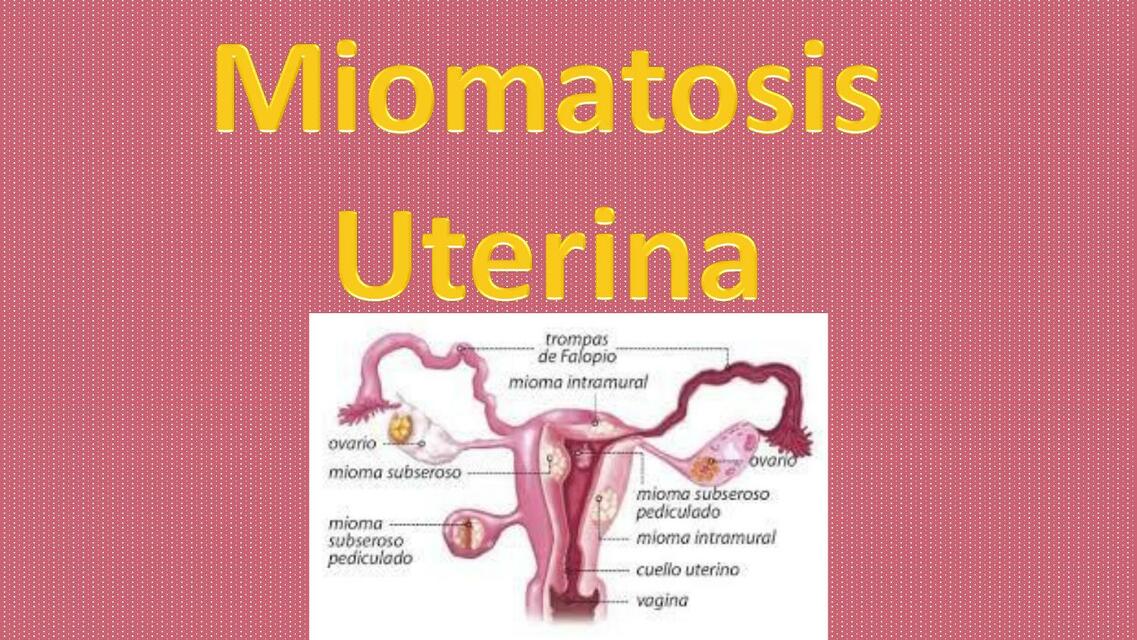 Miomatosis Uterina | MARYURI LISBETH | uDocz