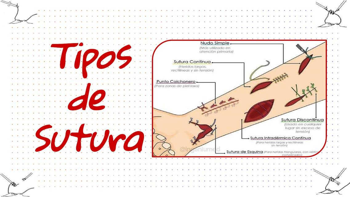Suturas Quirurgicas Que Son Tipos Tecnicas Y Agujas De Sutura Images Suturas Quirurgicas Que Son Tipos Tecnicas Y Agujas De Sutura Images