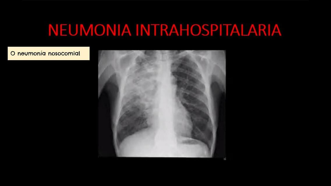 8. Neumonías Intrahispitalaria | LiquidOH愛 | uDocz