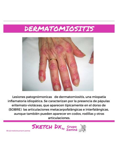 Dermatomiositis