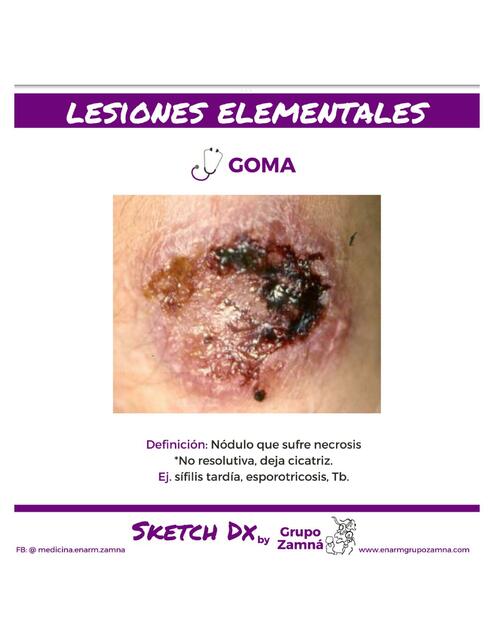 Lesiones Elementales: Goma | uDocz