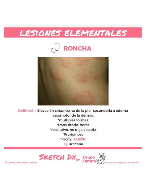 Lesiones Elementales: Roncha | uDocz