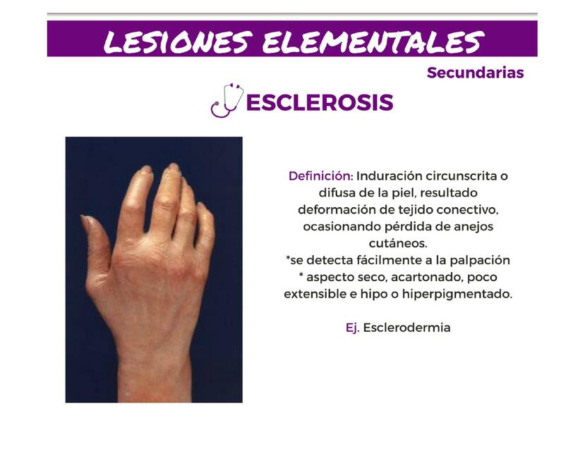 Esclerosis | uDocz