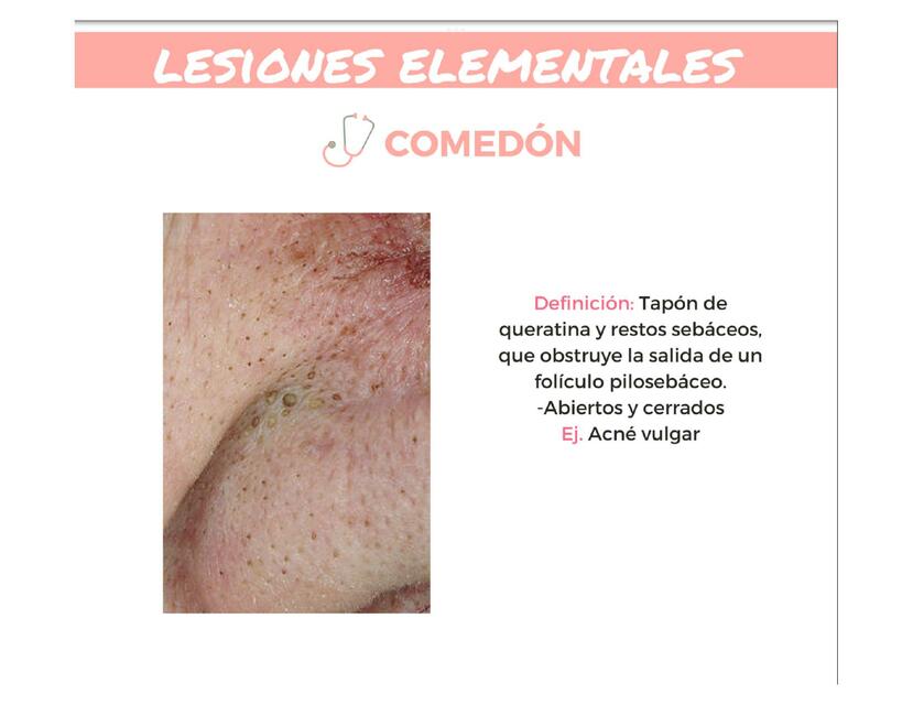 Comedón | uDocz