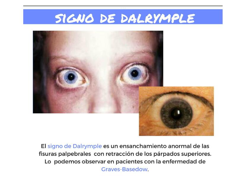 Signo de Darlymple | uDocz