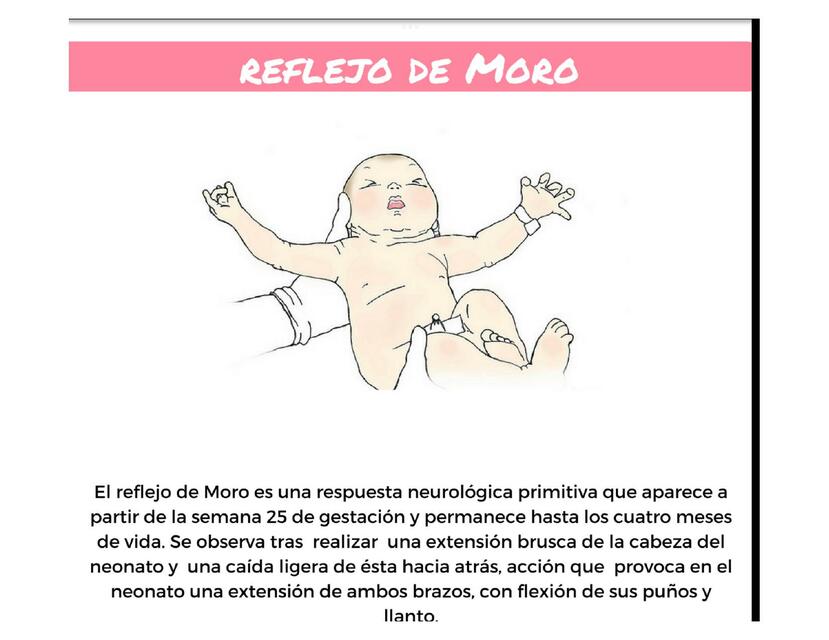 Reflejo de Moro | uDocz
