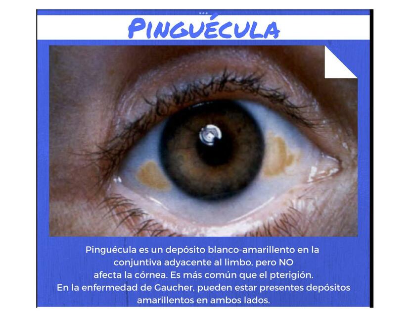 Pinguécula | uDocz