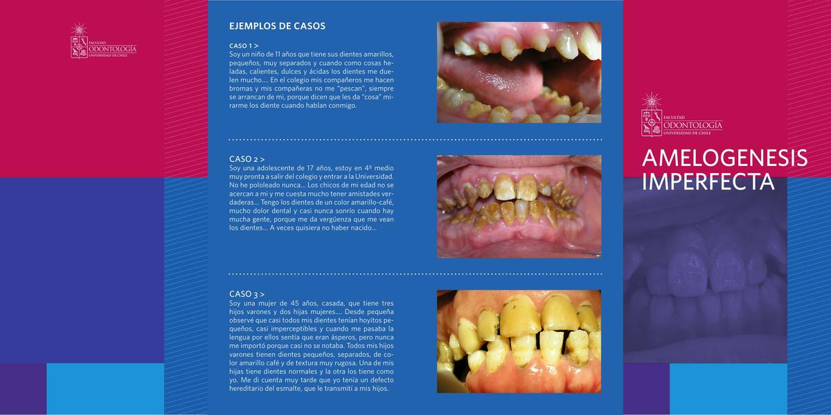 Amelogénesis Imperfecta | Mario Vilchis | uDocz