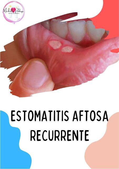 Estomatitis aftosa recurrente | Michelle Pedroza | uDocz