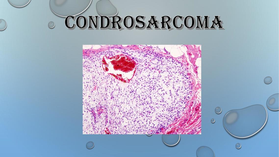 Condrosarcoma | META | uDocz