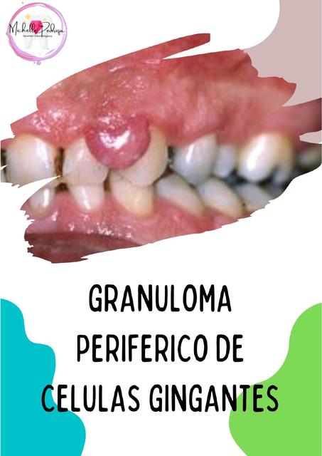 Radiografia Periferica De Granuloma De Celulas Gigantes Tumores De
