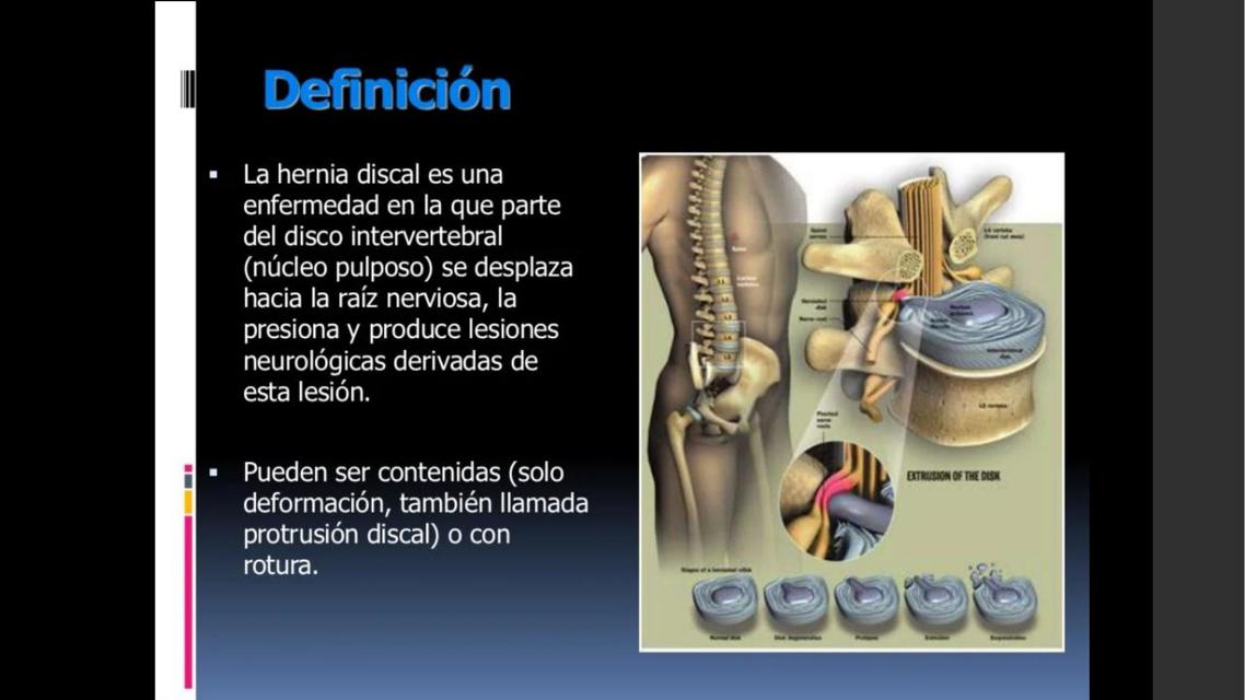 Hernia de Disco | META | uDocz