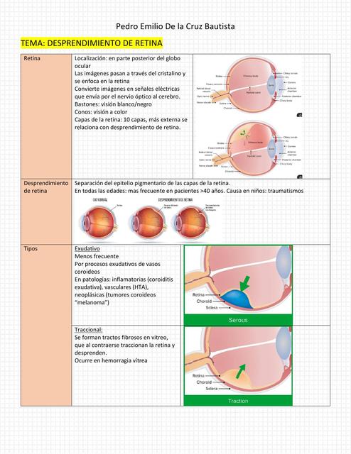 Desprendimiento de retina | DR. PEDRO EMILIO | uDocz