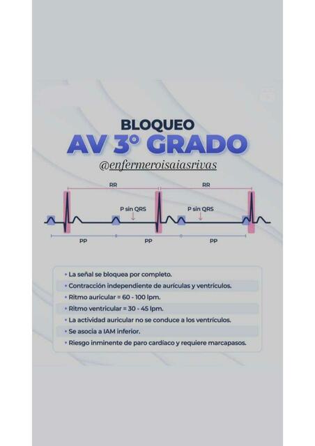 Bloqueo AV 3° Grado | Enfermero Isaias Rivas | uDocz