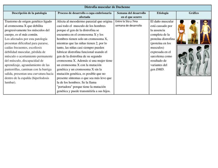 Distrofia Muscular de Duchenne | Ayelen Adamaris Suarez Sabando | uDocz