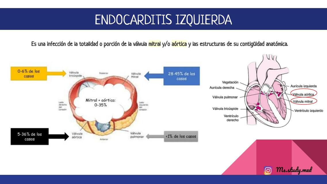 Endocarditis Infecciosa | Ms.study.med | uDocz