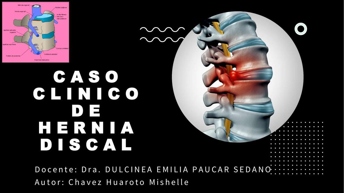 Caso Clínico de Hernia Discal | Mishelle Chavez | uDocz