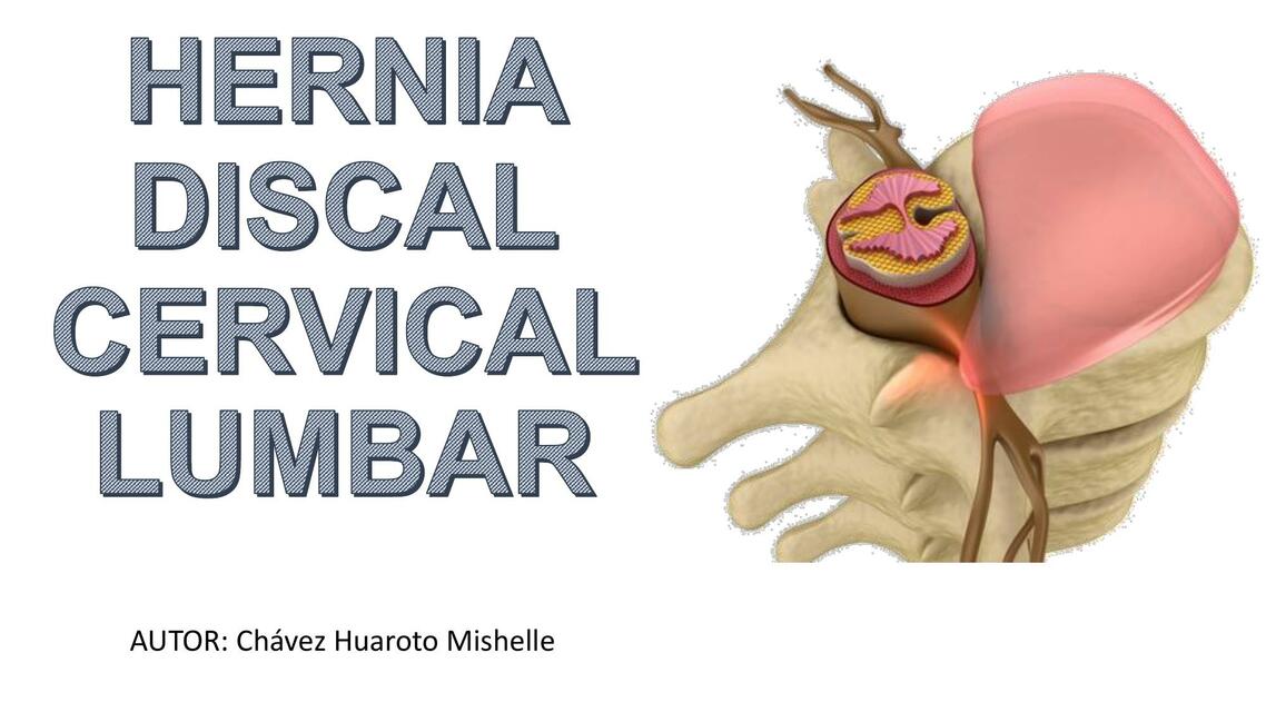 Resúmenes de Etapas de hernia cervical | Descarga apuntes de Etapas de ...