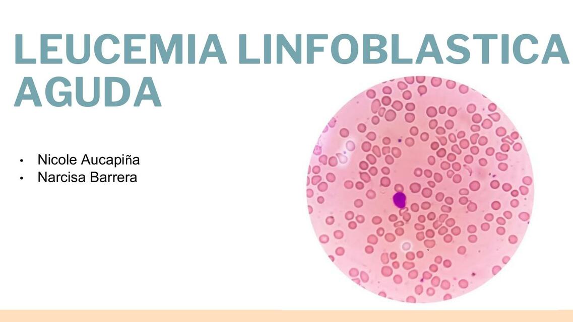 Leucemia Linfoblástica Aguda | NICO AUCAPIÑA | uDocz