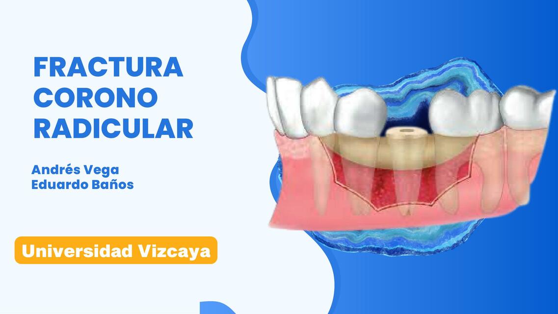 Fractura Corono Radicular | Andrés Vega | uDocz